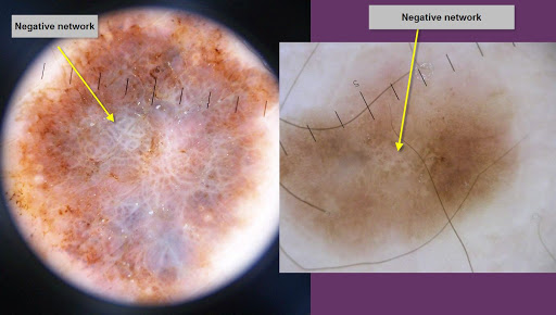 Dermoscopy Features as Clues: White lines