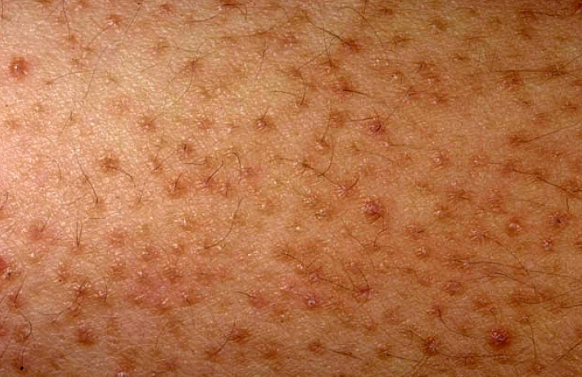 Bagaimana Cara Menyembuhkan Bintik-Bintik Hitam pada Kulit - Blog ...