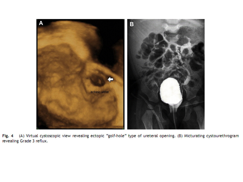 BÀI SOẠN VỀ SIÊU ÂM CHẨN ĐOÁN: VIRTUAL CYSTOSCOPY USING 3D ULTRASOUND