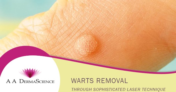 Dermatologist Clinic in Gurgaon: Warts Removal through Sophisticated ...