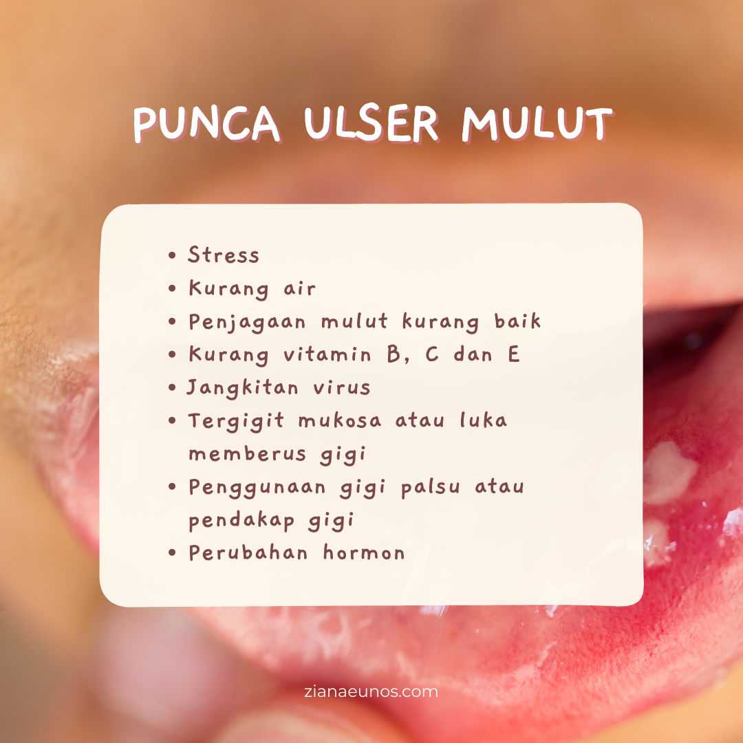 Punca dan Cara Atasi Ulser Mulut