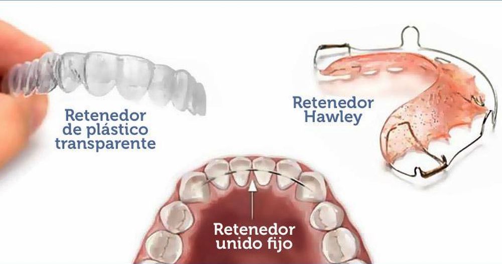 RETENEDORES: Qué pasa con tus dientes cuando terminas tratamiento de ...