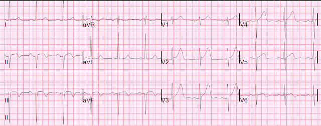 Dr. Smith's ECG Blog: LVH with expected repolarization abnormalities ...