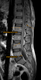 Arachnoiditis-MRI - Sumer's Radiology Blog