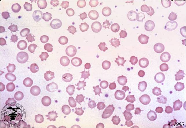 Biometria Hematica: Alteraciones de los Eritrocitos