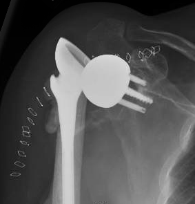 UW Shoulder and Elbow Academy: Reverse total shoulder - dislocations ...