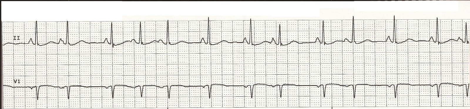EKG Rhythm Strips 59