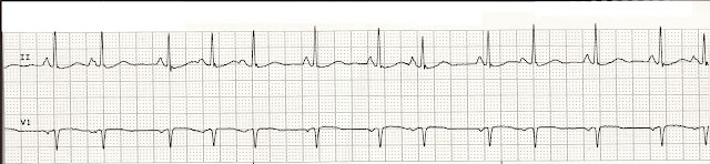 EKG Rhythm Strips 59