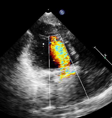 HealthforHeart: Situs inversus dextrocardia associated corrected ...