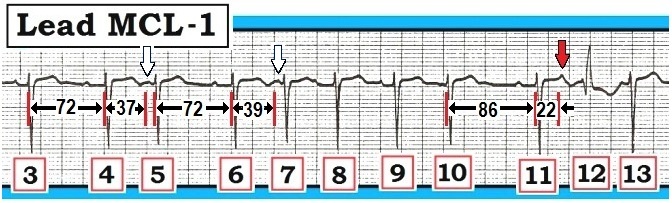 ECG Interpretation: ECG Blog #70 (PVC – Aberrancy – Ashman)