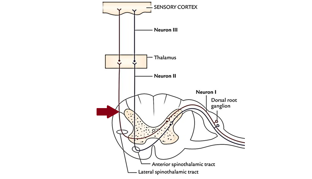 easyhumanatomy: Lateral spinothalamic tract