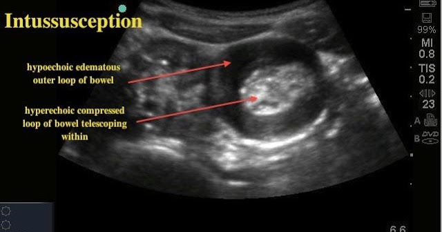 MEDICAL ULTRASOUND/ INTUSSUSCEPTION