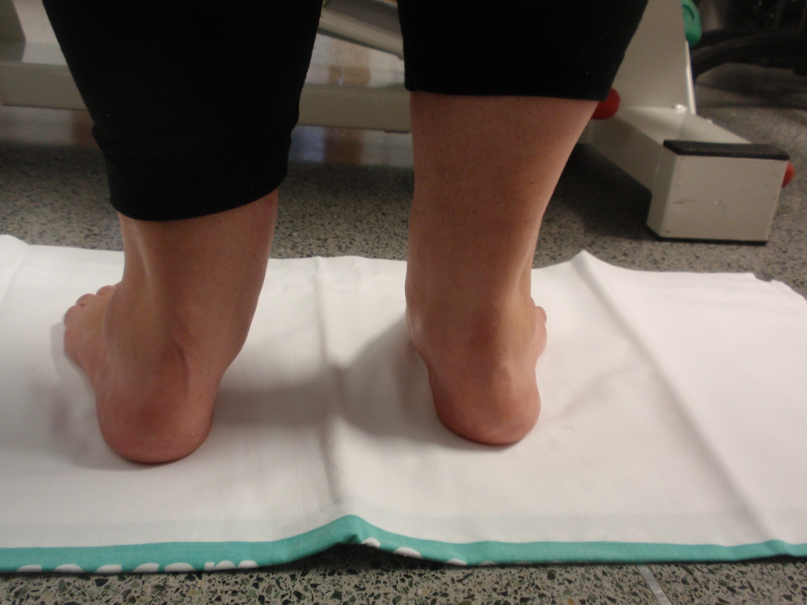 Fanáticos del pie: ATLAS DE PATOLOGÍA DEL PIE: PIE PLANO VALGO