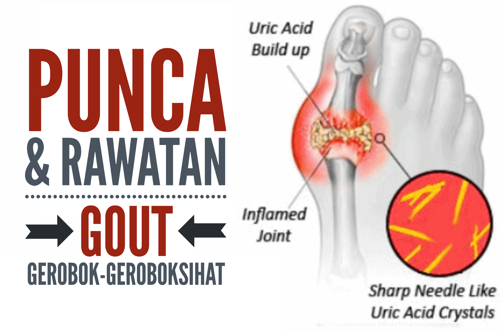 PUNCA DAN RAWATAN PENYAKIT GOUT