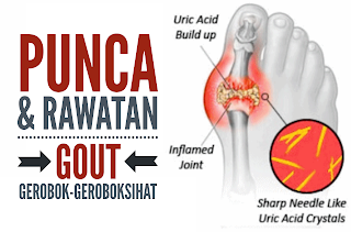 PUNCA DAN RAWATAN PENYAKIT GOUT