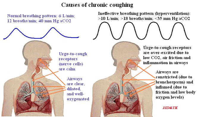 Chronic Cough