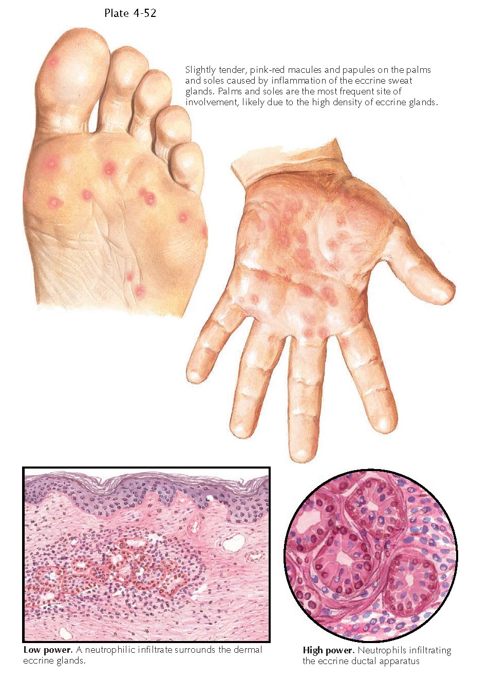 NEUTROPHILIC ECCRINE HIDRADENITIS - pediagenosis