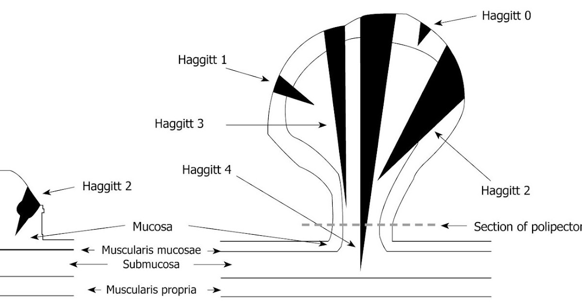 Radiotherapy Dictionary: Haggitt classification of colorectal polyps