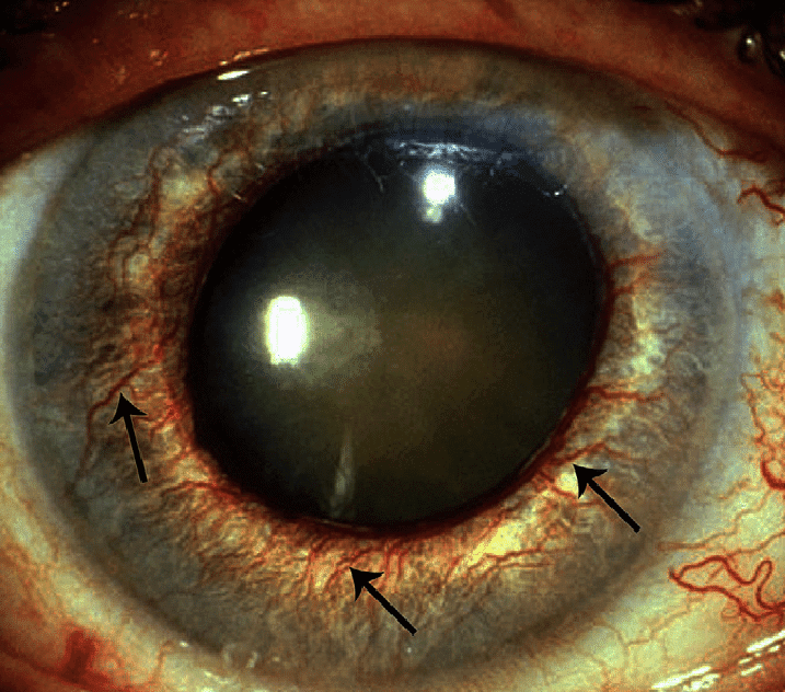 Glaucoma Neovascular