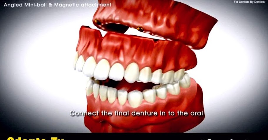 CLINICAL CASE: Implant supported Mx.overdenture (Using magnetic ...