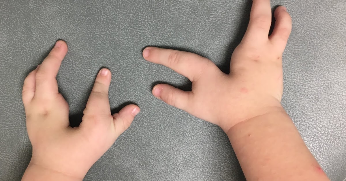 Untreated Cleft Hand | Congenital Hand and Arm Differences