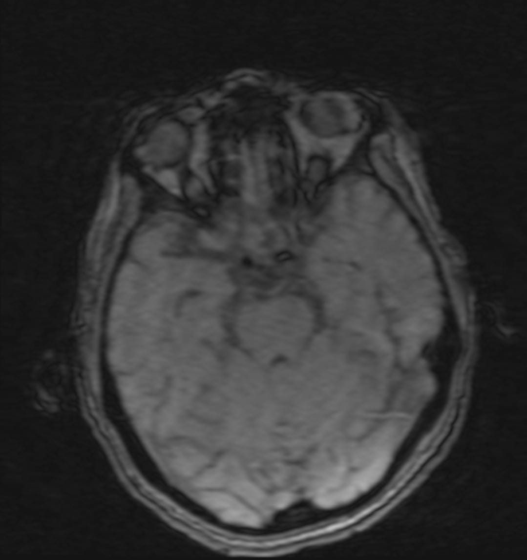 50/M with progressive supranuclear palsy with status epilepticus ...