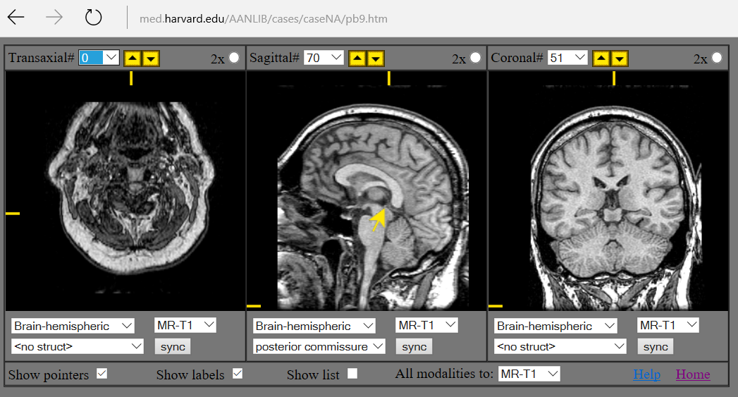 Intraoperative NeuroMonitoring: Whole Brain Atlas: This Online Whole ...