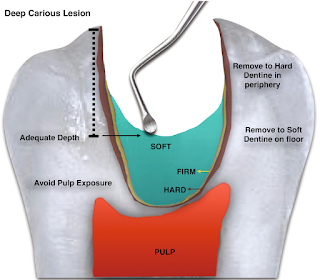 Management of deep caries (14)