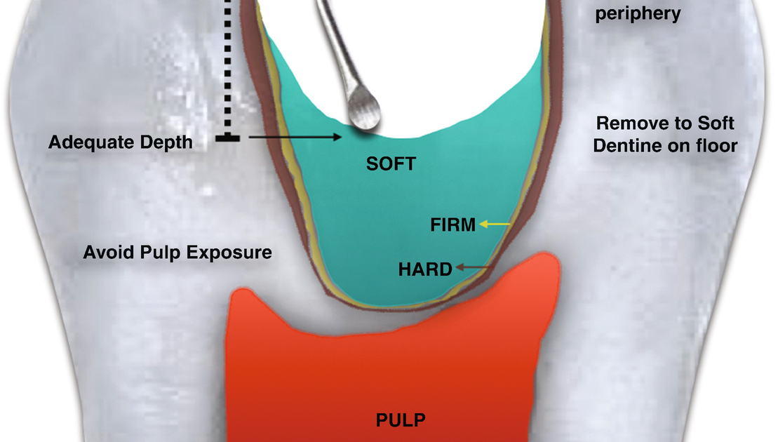 Management of deep caries (14)