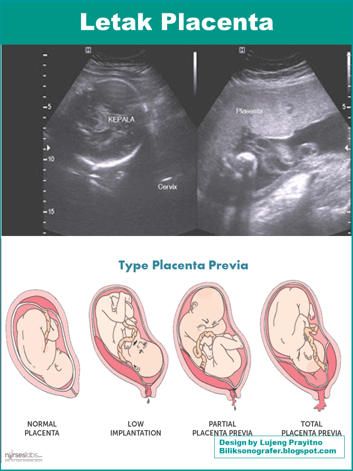 Pemeriksaan Ultrasonografi (USG) Trimester 2/3