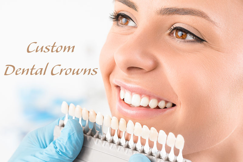 Yellowing Dental Crowns – Here’s What You Should Do