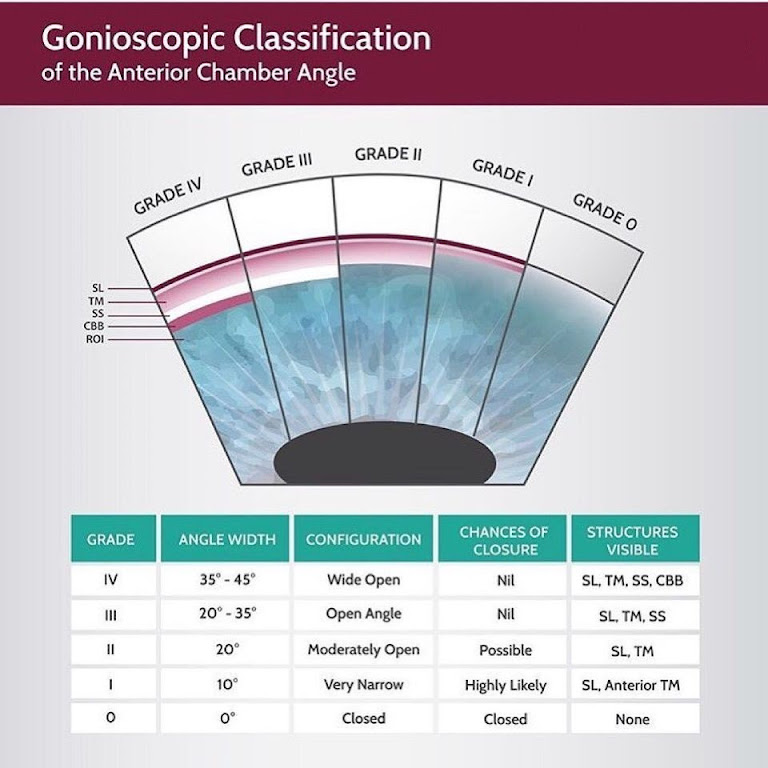 Ophthalmology Notes: Shaffer system- Gonioscopy
