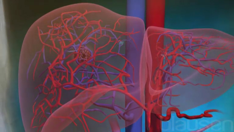 Uniprocto e Gastro: O que é cirrose hepática?