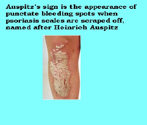 DENTAL AIPG MOST ASKED TOPICS: auspitz's sign