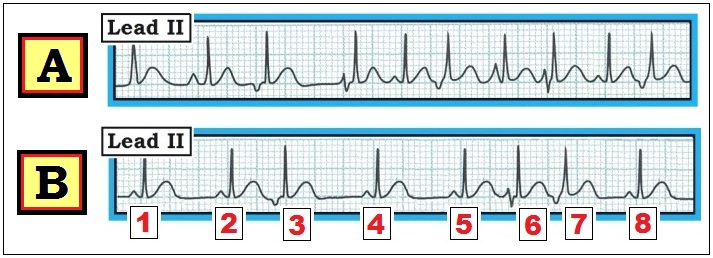ECG Interpretation: ECG Blog #65 (AFib - RVH - Wandering - MAT)