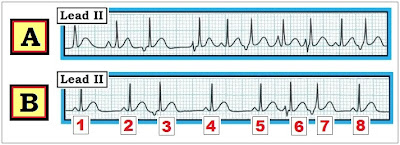 ECG Interpretation: ECG Blog #65 (AFib - RVH - Wandering - MAT)