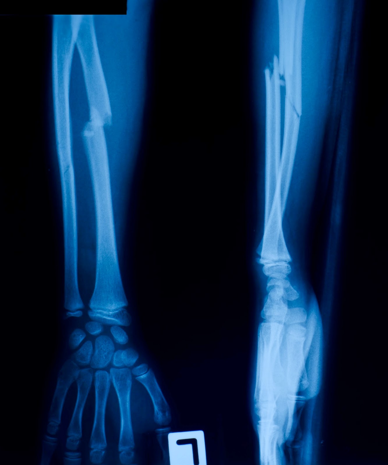 Når man får en fraktur: Frakturer