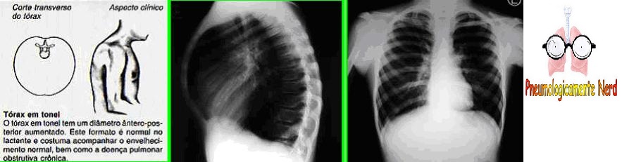 Pneumologicamente Nerd: Tipos de tórax
