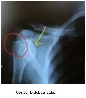 sikkahoder: DISLOKASI TULANG AKIBAT FRACTURE