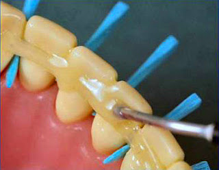 AKJ Dental Hospital Shenzhen : Is Periodontal Splinting Painful for ...