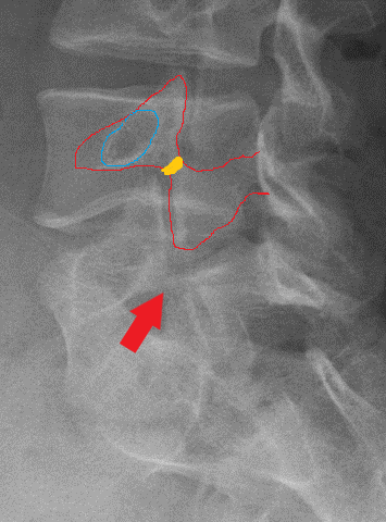 Spondylolysis or Pars Fracture | Growing Spine Blog | Washington ...
