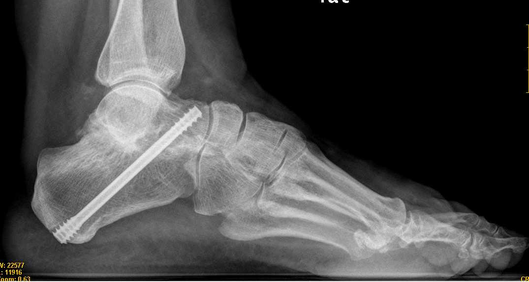 Fanáticos del pie: CASO CLINICO ARTRODESIS SUBASTRAGALINA