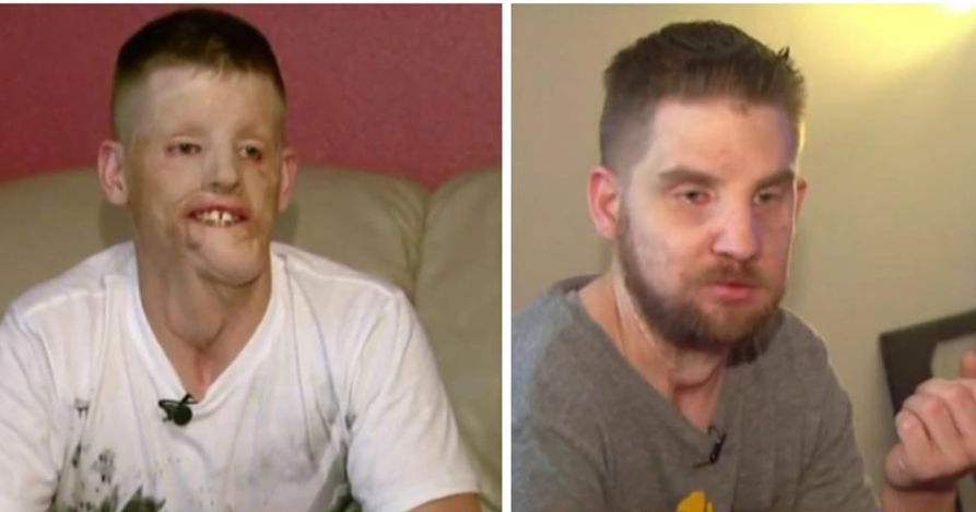 Mitchell Hunter discusses face transplant five years later ~ Sandra ...