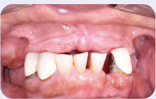 Combination syndrome