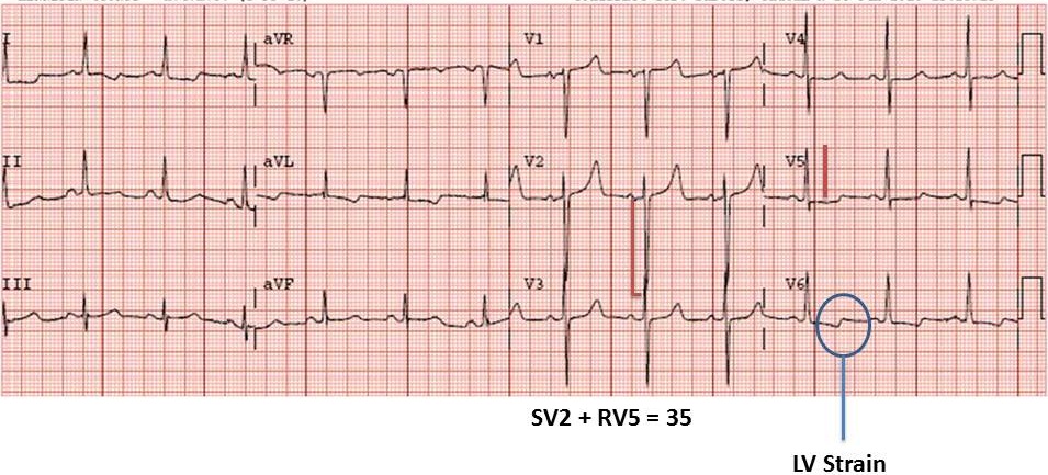 Me You n our similarity,.: Left Ventricular Hypertrophy (LVH), LV ...