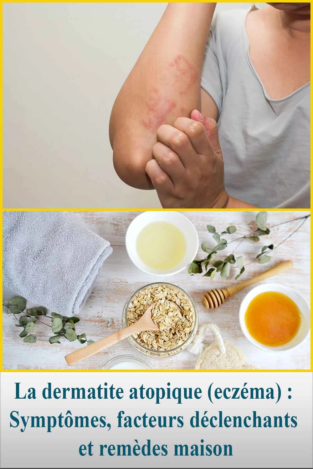 La dermatite atopique (eczéma) : Symptômes, facteurs déclenchants et ...