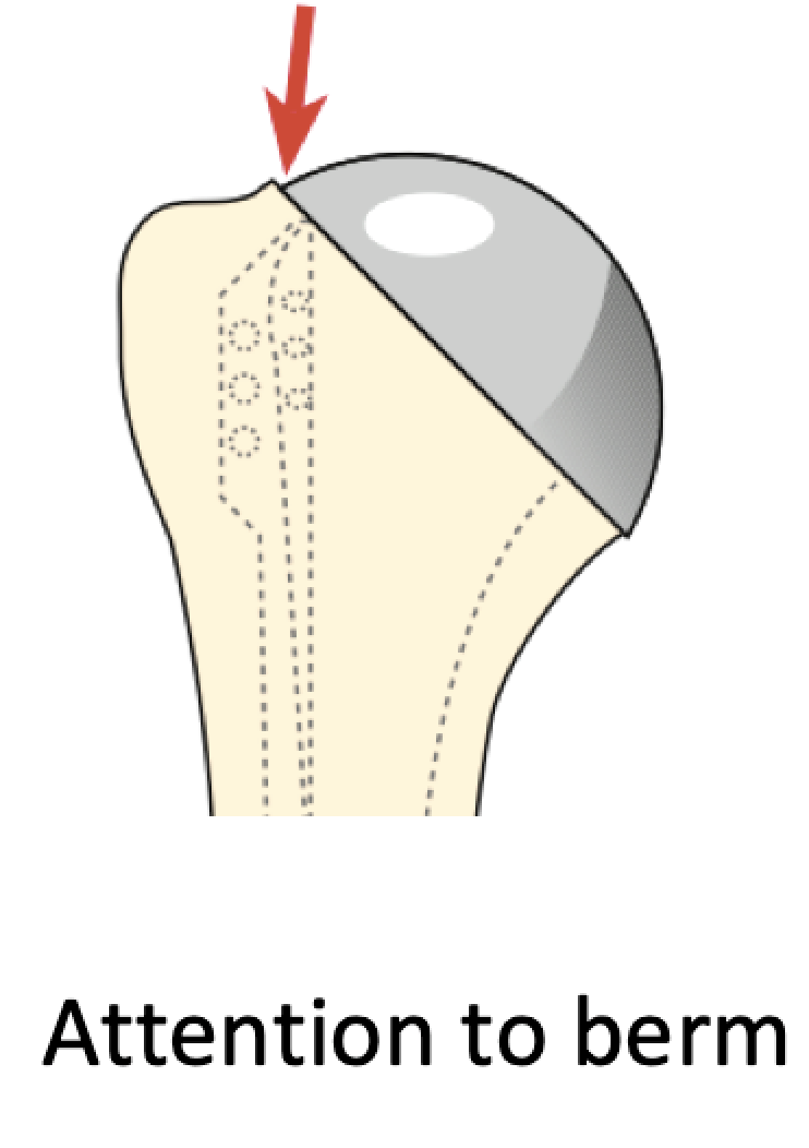 UW Shoulder and Elbow Academy: Overstuffing and the importance of ...