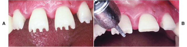 Odontology Student: Prosthodontics: The Metal-Ceramic Crown Preparation ...