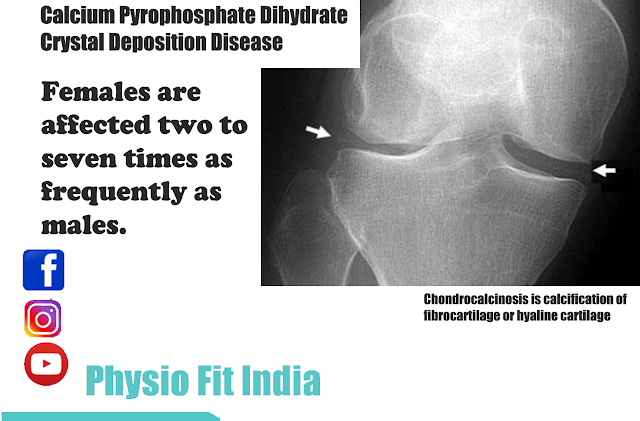CPPD Calcium Pyrophosphate Dihydrate Crystal Deposition Disease