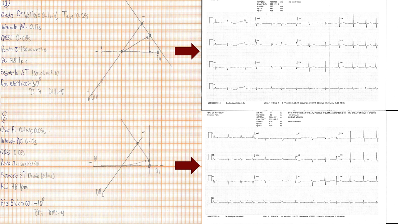 Fisiología Básica: Electrocardiograma - Interpretación y Eje eléctrico